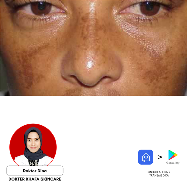 Definisi dan penyebab flek hitam-melasma - KHAFA SKIN CARE